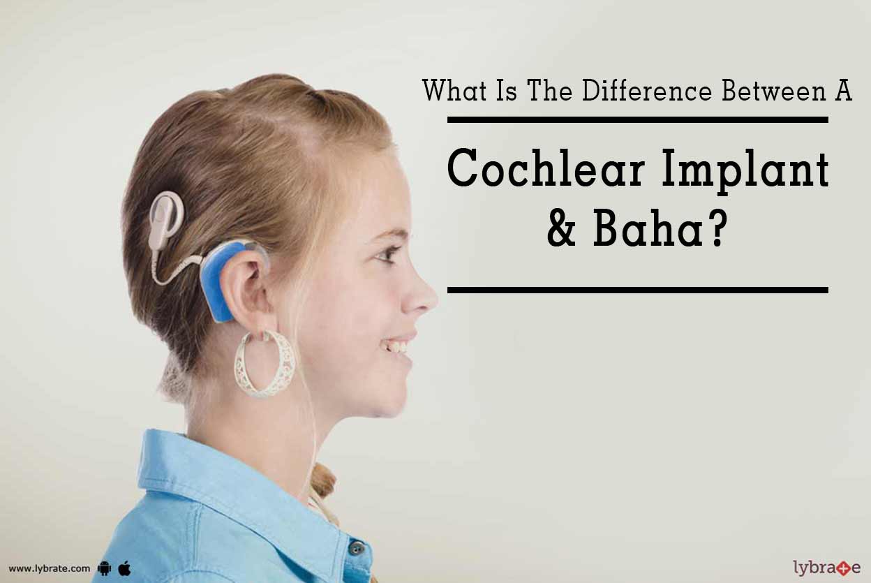 Cochlear Baha