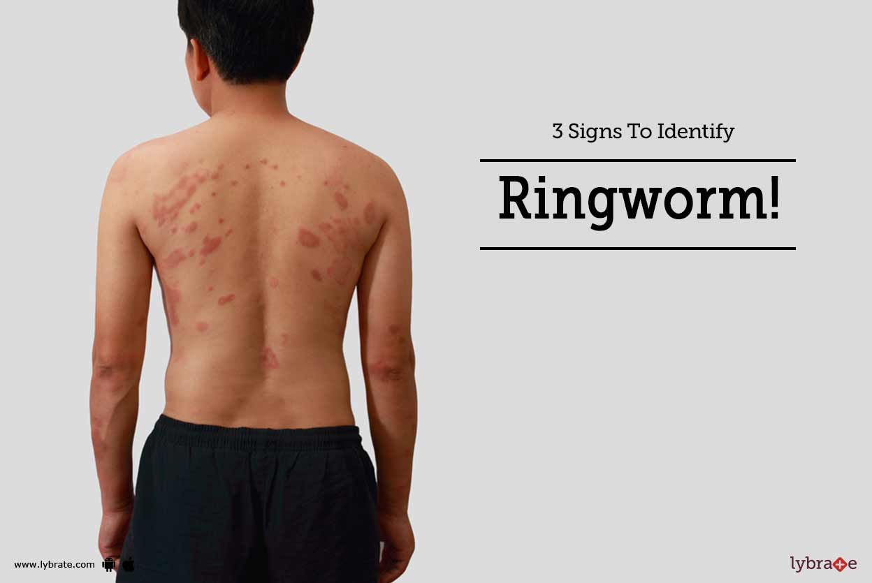 3 Signs To Identify Ringworm! - By Dr. Mukesh Singh | Lybrate