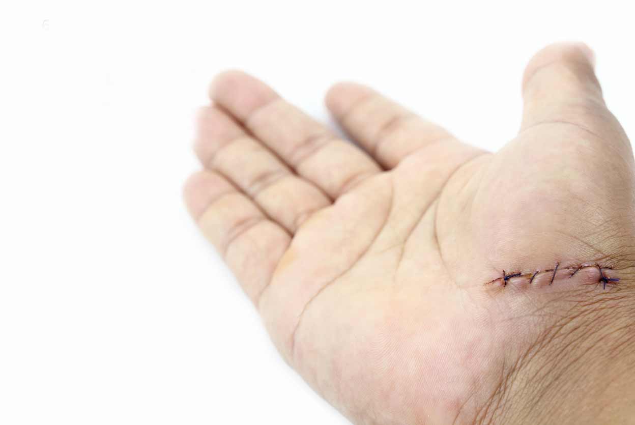 How You Should Take Care Of Stitches Post-Surgery? - By Dr. Ajay Gupta ...