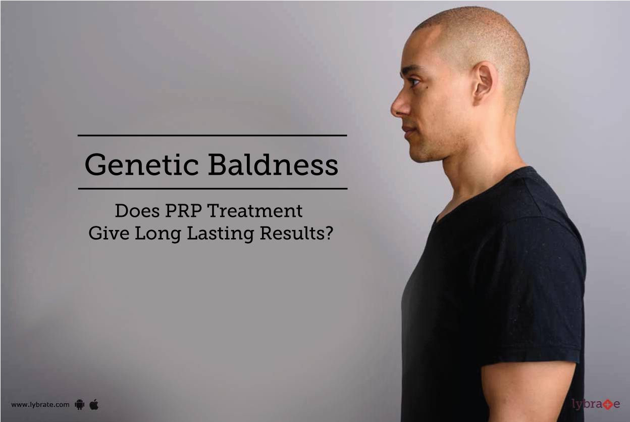 Genetic Baldness - Does PRP Treatment Give Long Lasting Results? - By ...