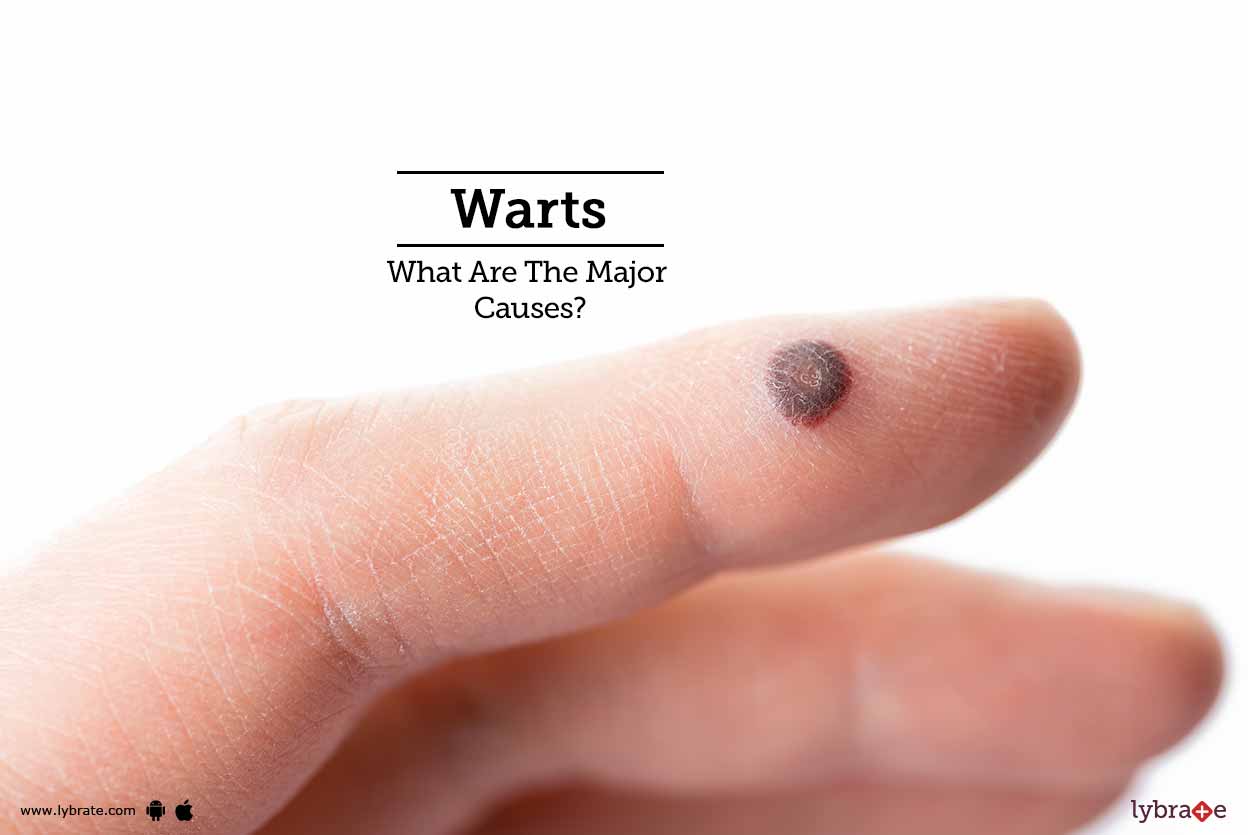 Warts - What Are The Major Causes? - By Dr. N Hari Krishna Reddy | Lybrate