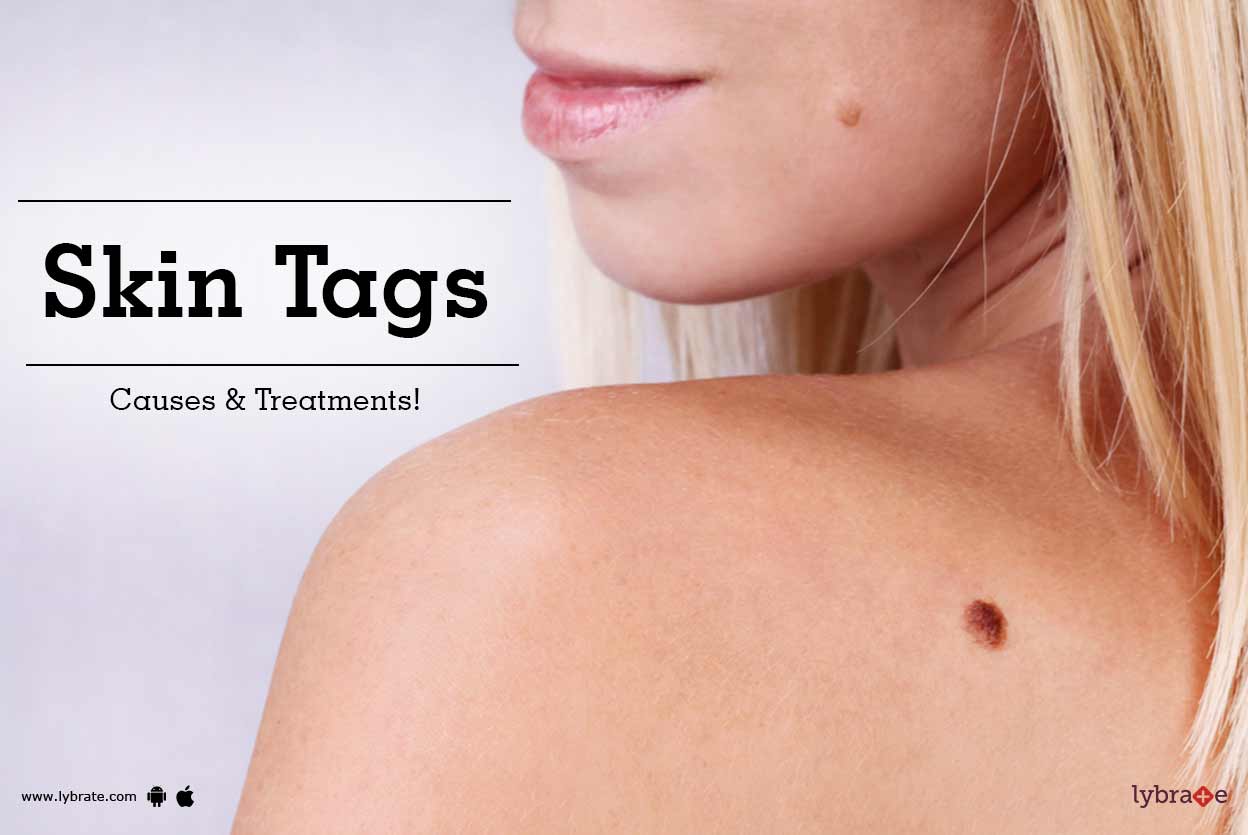 Skin Tags - Causes & Treatments! - By Dr. Sharat Gupta | Lybrate
