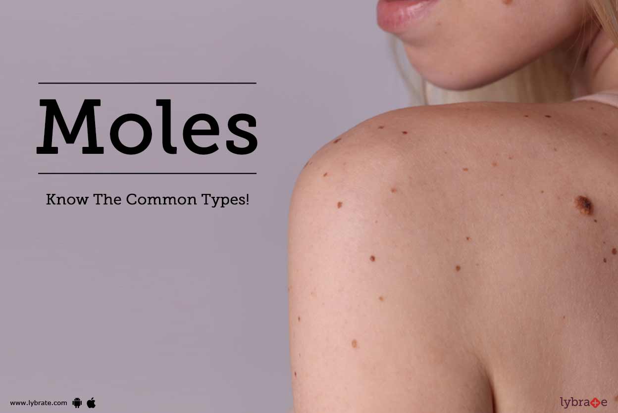 Moles - Know The Common Types! - By Dr. Jyoti Chourasia | Lybrate