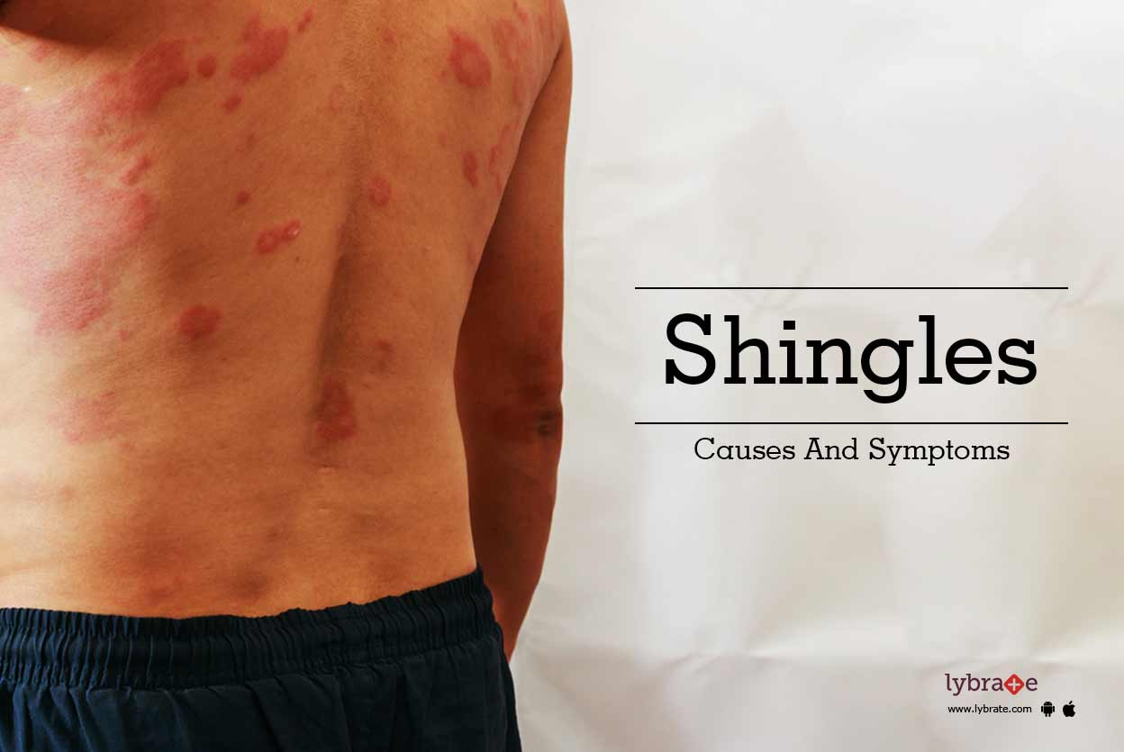 Shingles - Causes And Symptoms - By Dr. Jangid Skin Ex.Sr A.I.I.M.S ...