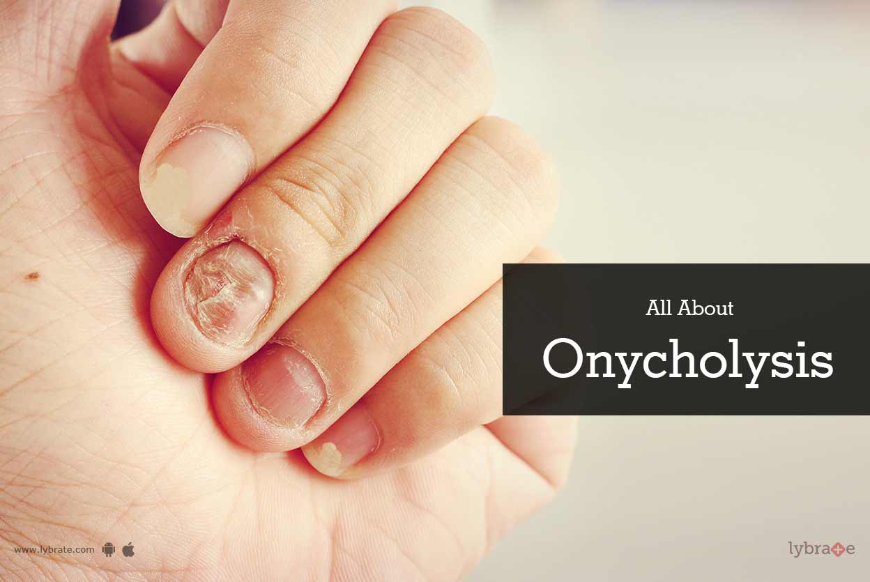 All About Onycholysis - By Dr. Aman Sharma | Lybrate