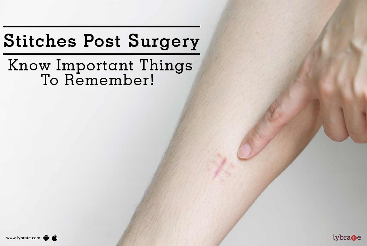 Stitches Post Surgery - Know Important Things To Remember! - By Dr ...