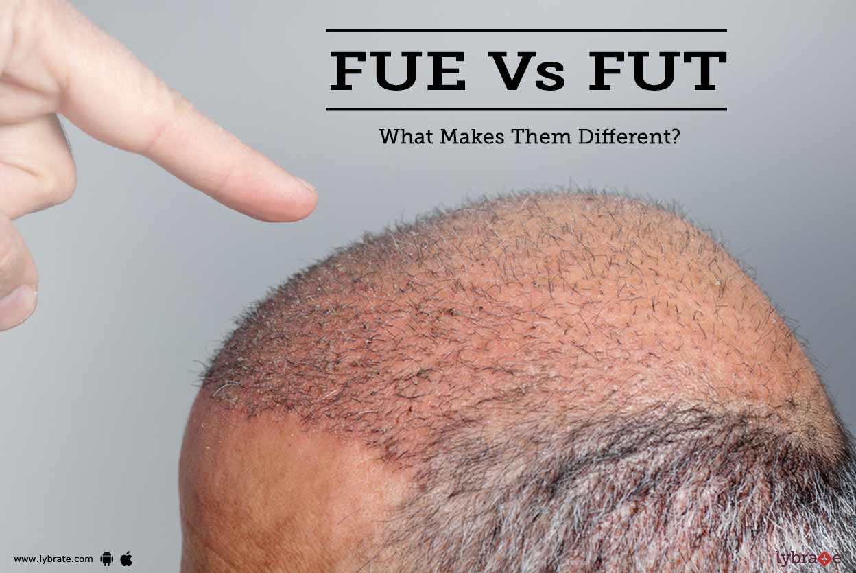 FUE Vs FUT - What Makes Them Different? - By Dr. Rohit Shah | Lybrate