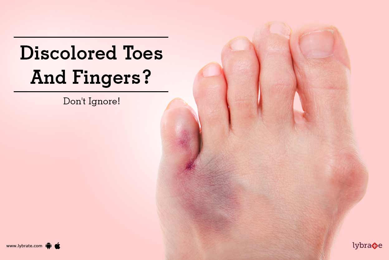 Discolored Toes And Fingers? Don't Ignore! - By Dr. Rahul. N.S | Lybrate