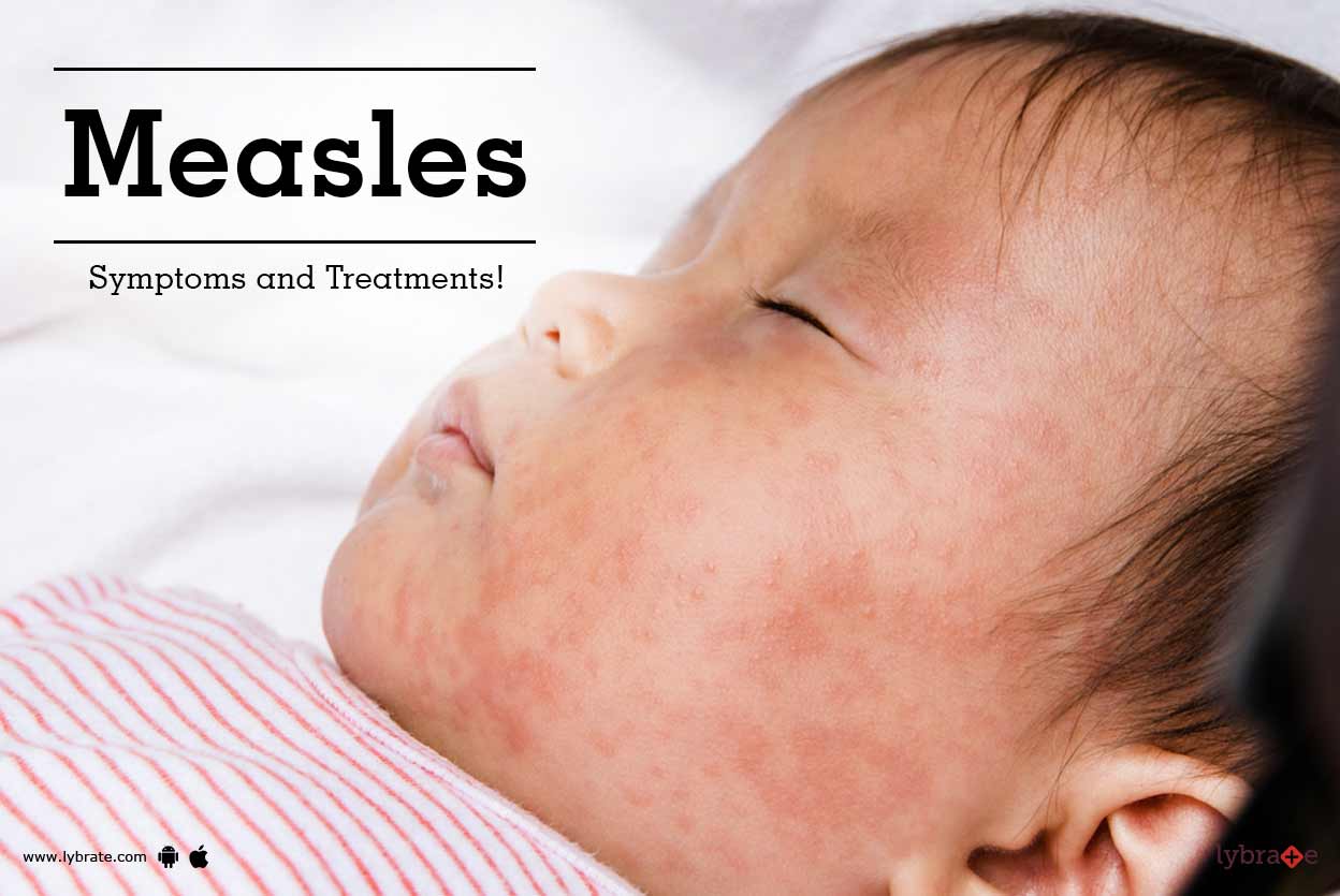 Measles: Symptoms and Treatments! - By Dr. Gayathri Devi | Lybrate