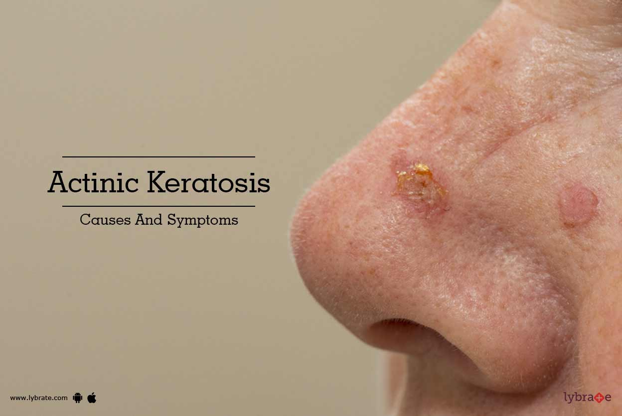Actinic Keratosis: Causes And Symptoms - By Dr. Amitoj Garg | Lybrate