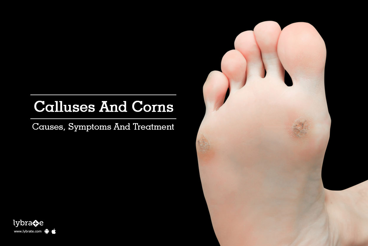 Calluses And Corns - Causes, Symptoms And Treatment - By Dr. Amitoj ...