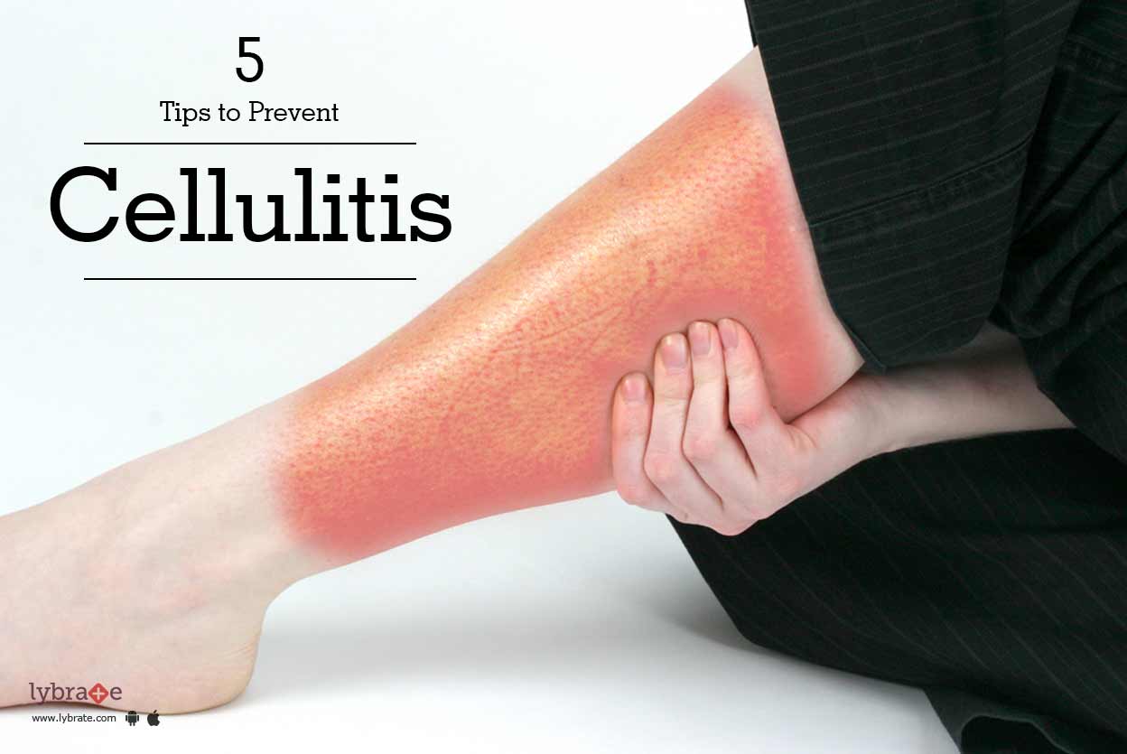 5 Tips To Prevent Cellulitis By Dr Rameshwar Madhukar Rao Gutte