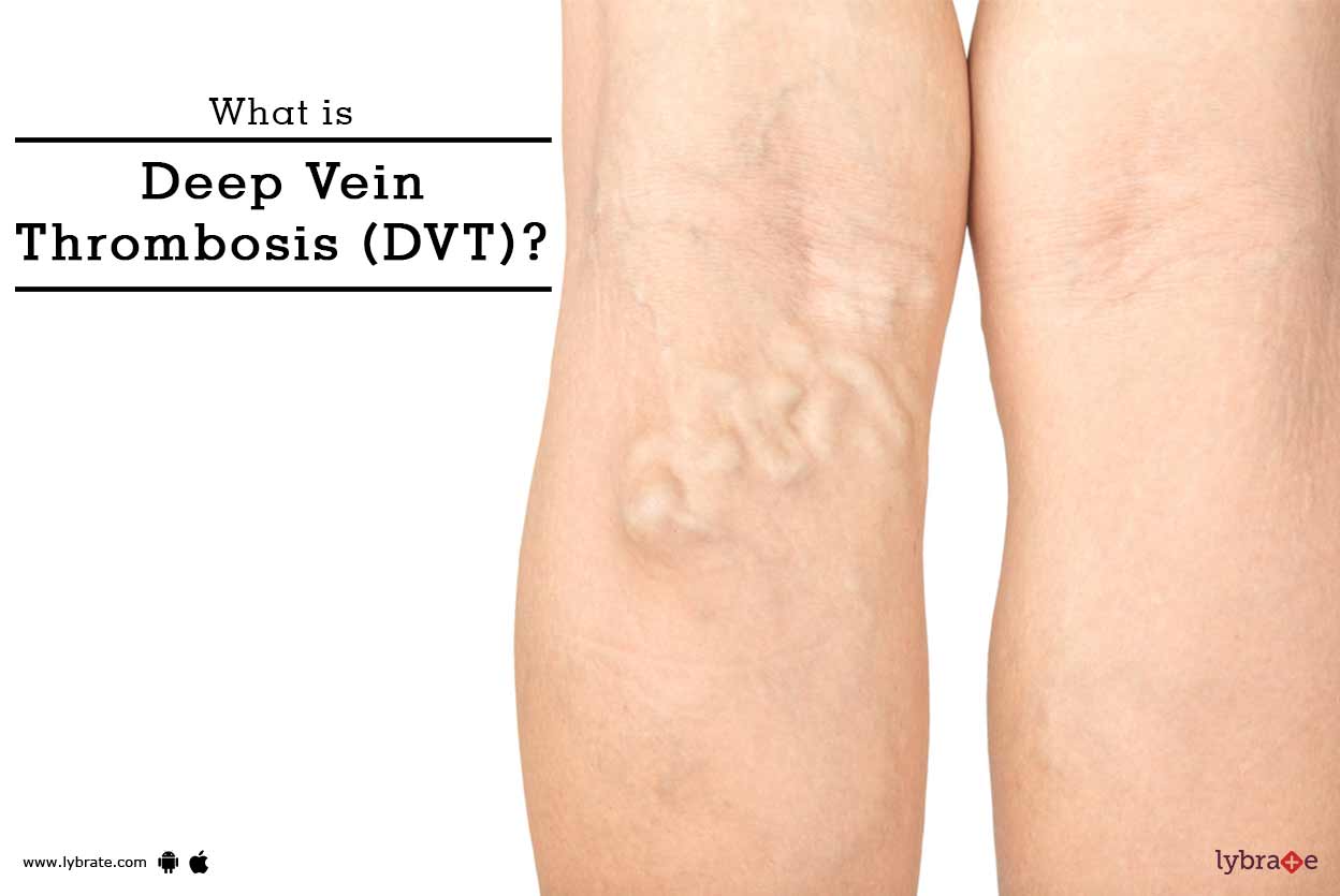 What Is Deep Vein Thrombosis DVT Symptoms Treatment Prevention What Is Deep Vein Thrombosis DVT Symptoms Treatment Prevention