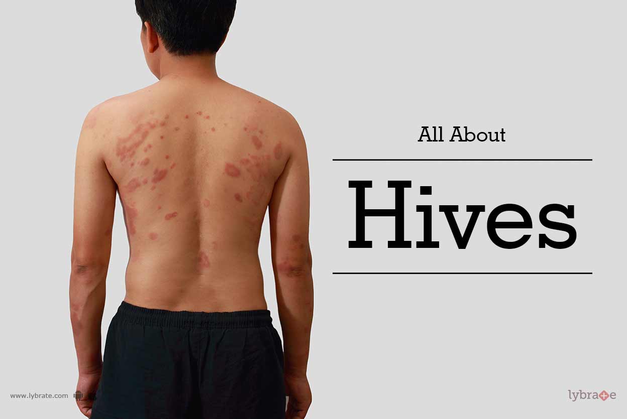 All About Hives - By Dr. Sanjay Vats | Lybrate
