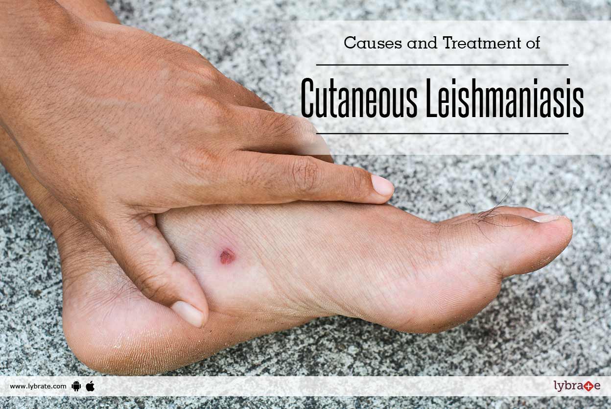 Causes and Treatment of Cutaneous Leishmaniasis - By Dr. Ravindranath ...