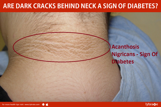 Are Dark Cracks Behind Neck A Sign Of Diabetes? - By Dr. Nikhil Prabhu ...