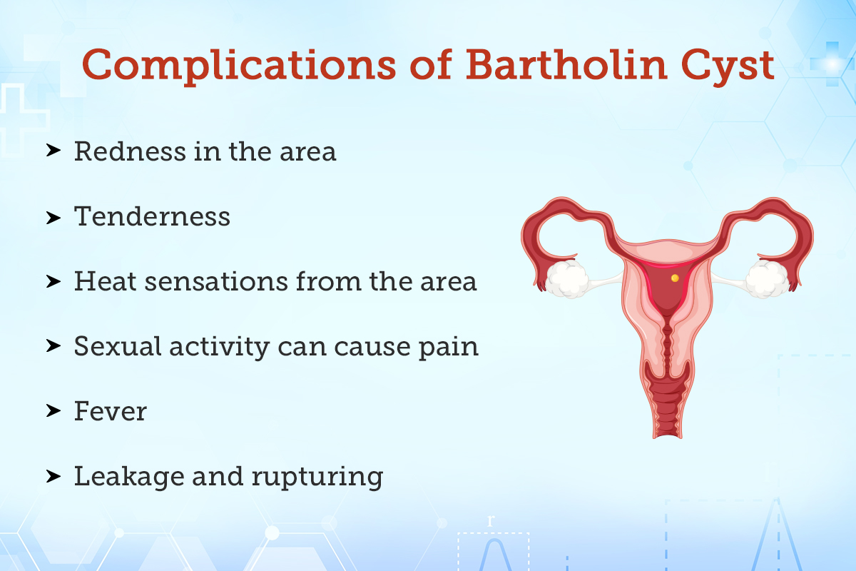 Bartholin Abscess: Treatment, Procedure, Cost, Recovery, Side Effects ...