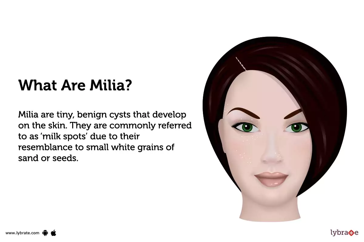 Milia (Milk Spots): Causes, Symptoms & Treatment