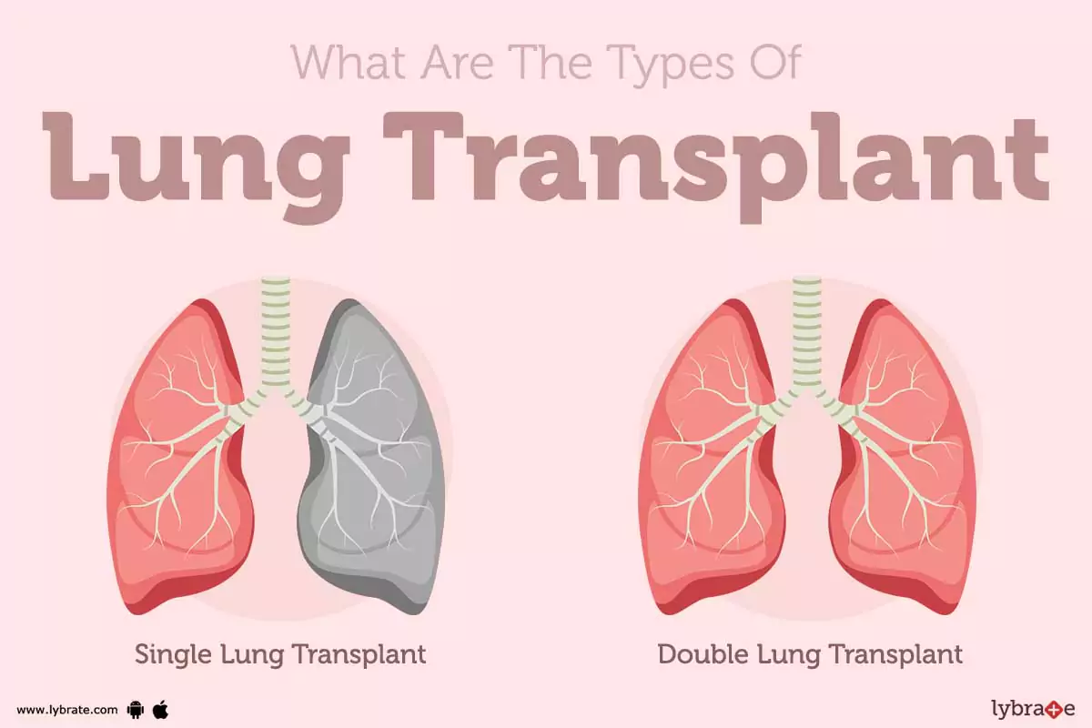 Lung Transplant: Causes, Symptoms, Treatment and Cost