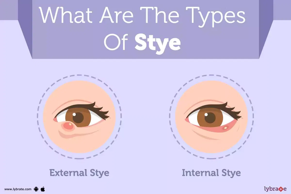 Stye Causes Symptoms Treatment And Cost