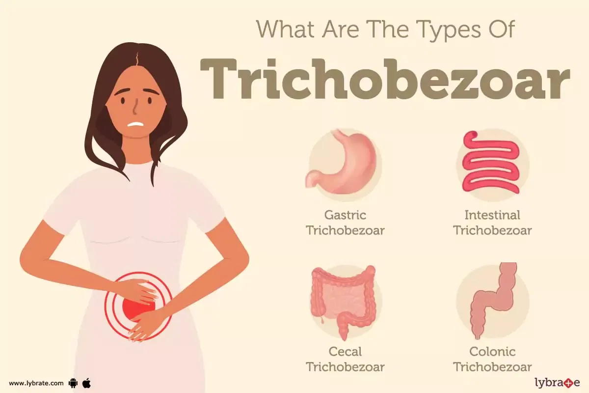Trichobezoar Causes Symptoms Treatment And Cost