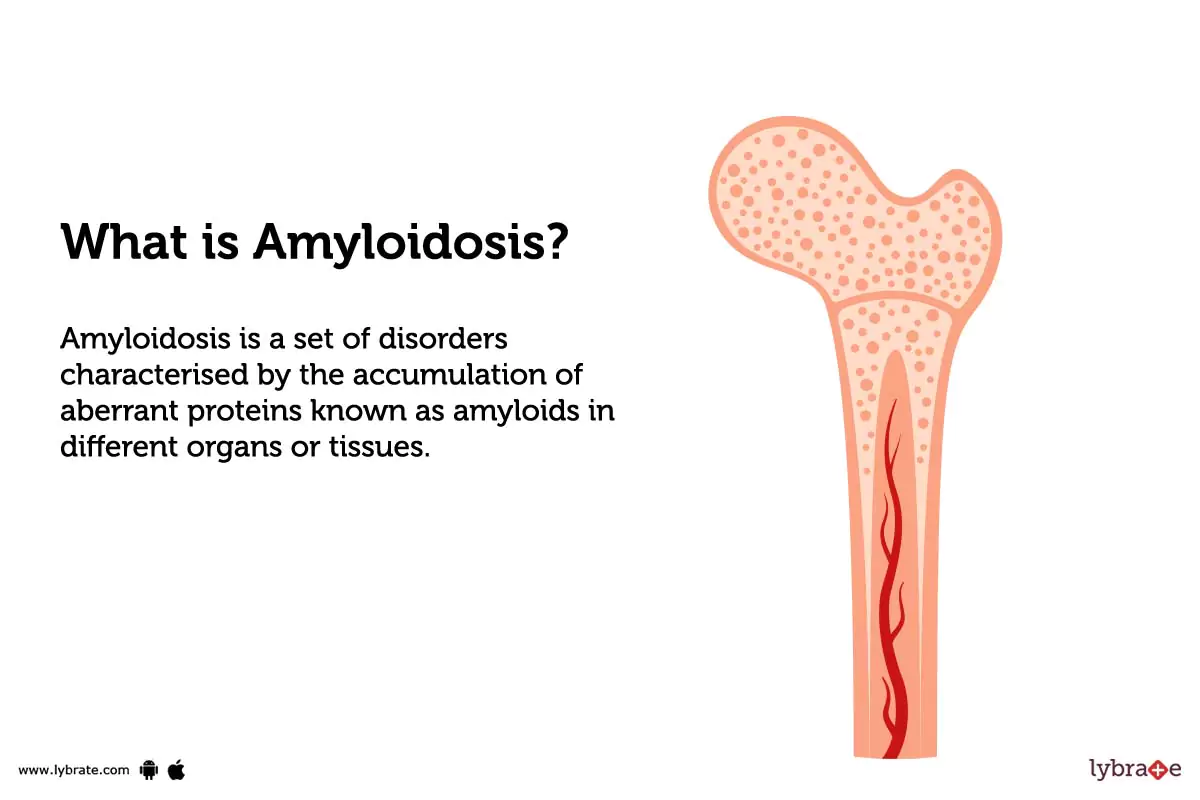 Amyloidosis: Causes, Symptoms, Treatment and Cost