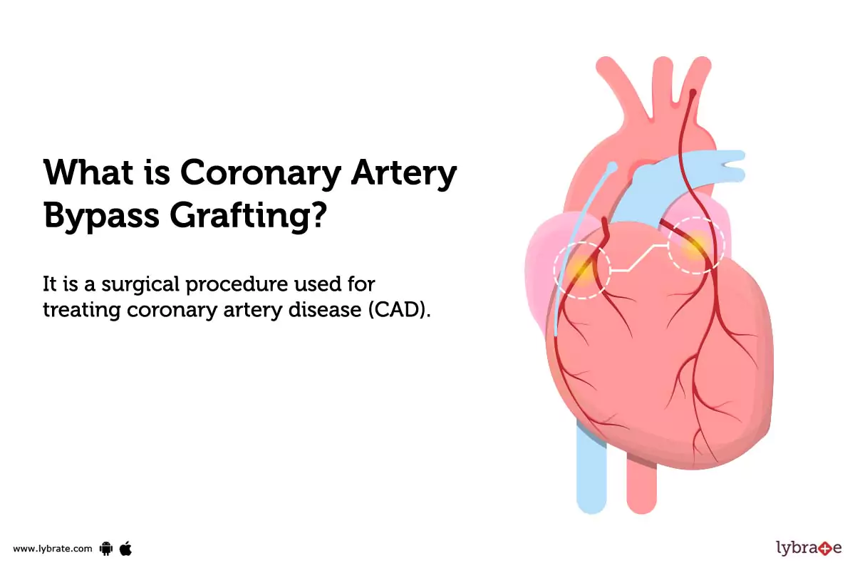 Coronary Artery Bypass Grafting: Purpose, Procedure, Benefits and Side ...