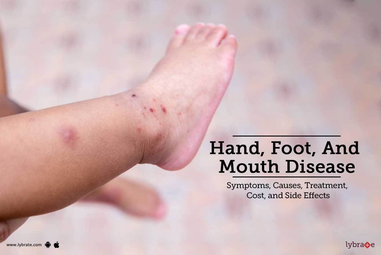 Hand, Foot, And Mouth Disease: Symptoms, Causes, Treatment, Cost, and ...