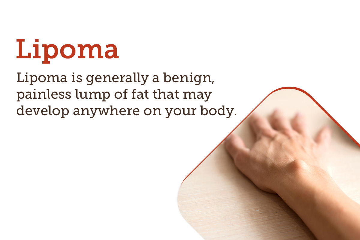 Lipoma: Symptoms, Causes, Treatment and Cost
