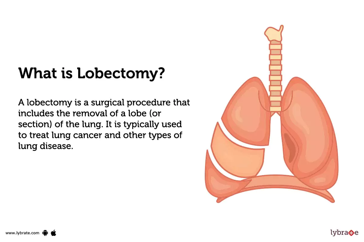 Lobectomy Causes Symptoms Treatment And Cost Lobectomy Causes Symptoms Treatment And Cost