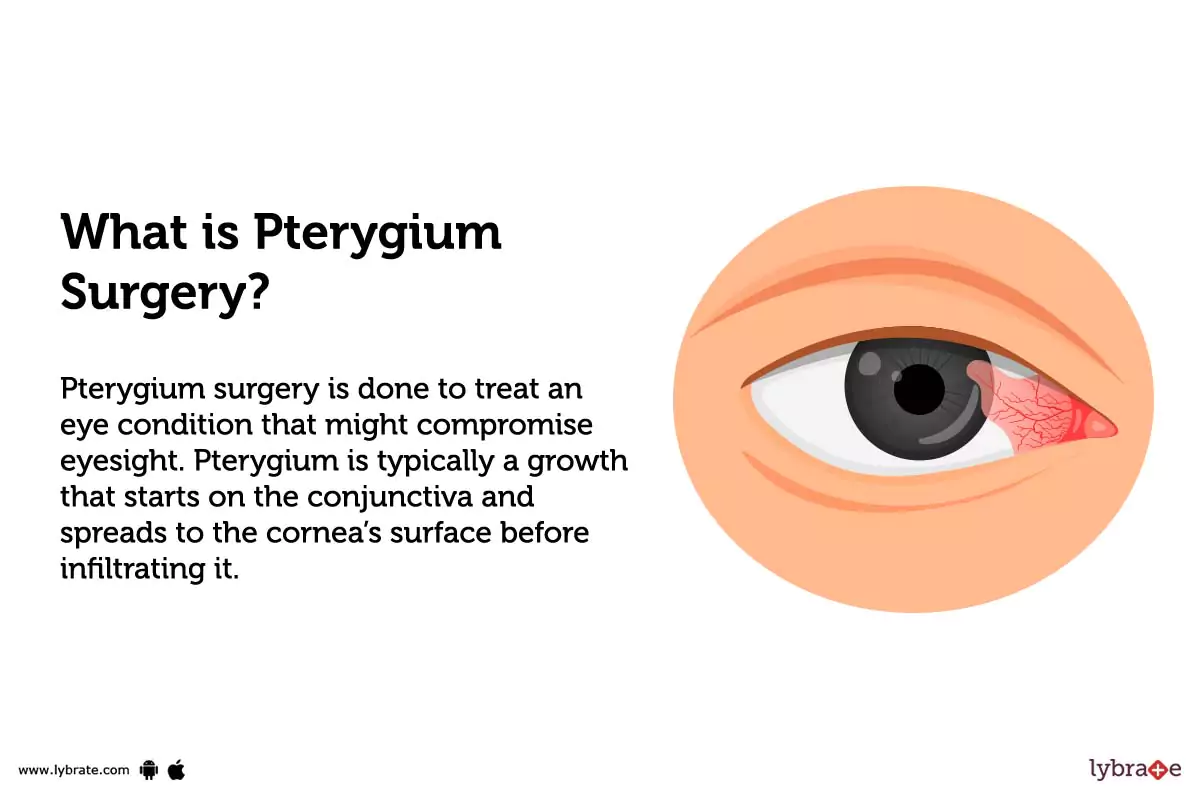 Pterygium Surgery: Purpose, Procedure, and Benefits and Side Effects