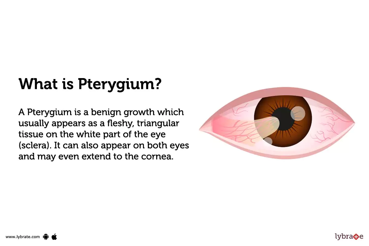 Pterygium: Causes, Symptoms, Treatment and Cost