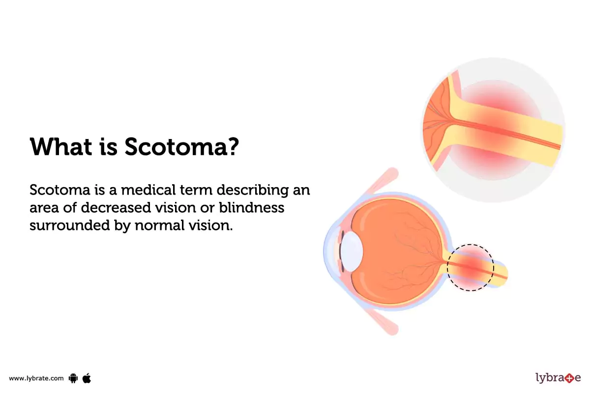 Scotoma: Causes, Symptoms, Treatment and Cost