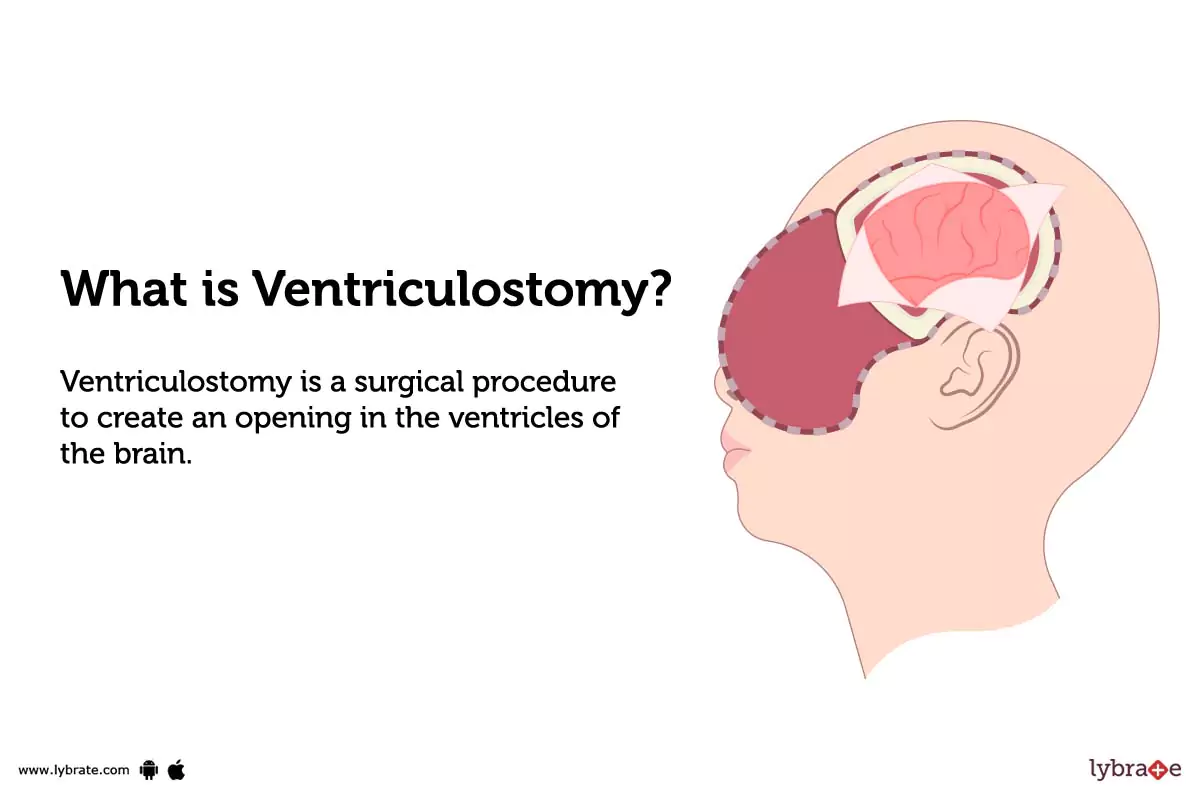 Ventriculostomy: Causes, Symptoms, Treatment and Cost