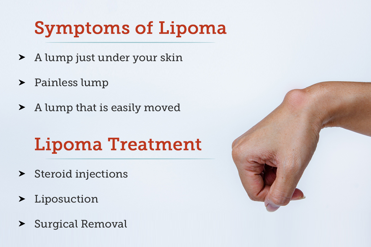 Lipoma: Symptoms, Causes, Treatment and Cost