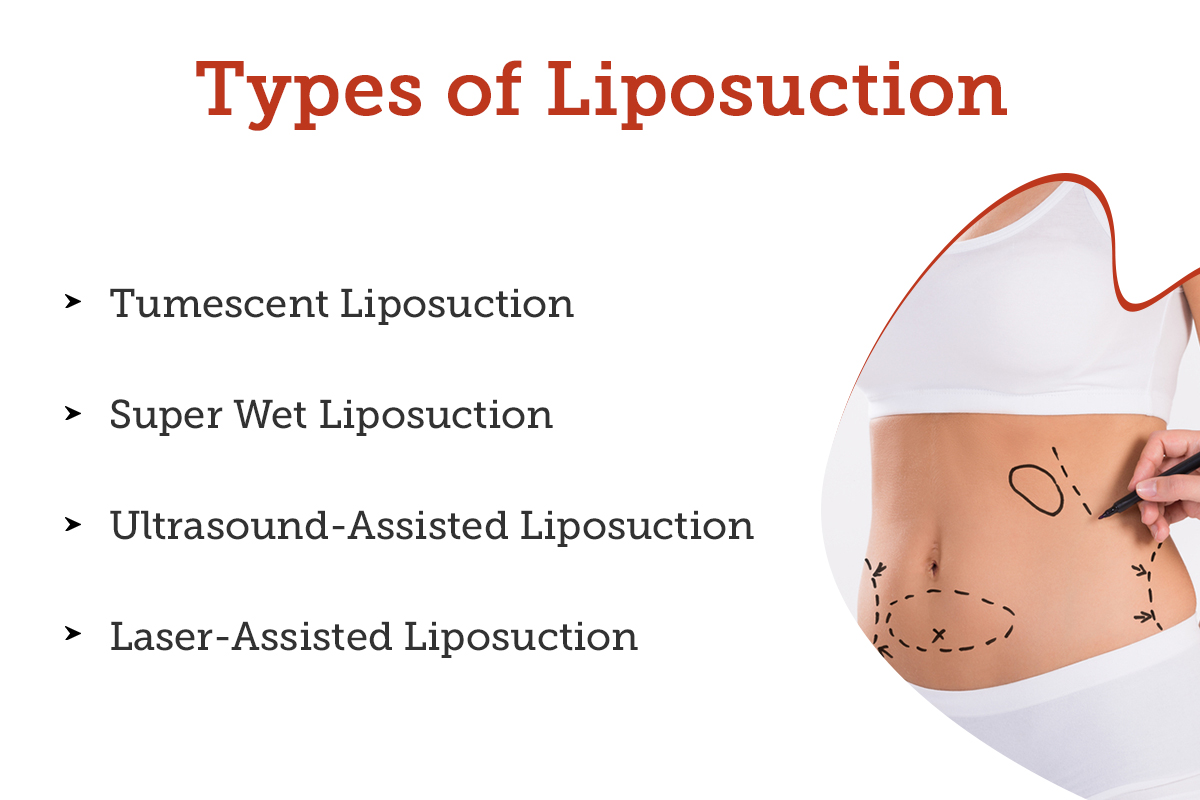 Liposuction - Types, Procedure, Diet, Cost And Side Effects