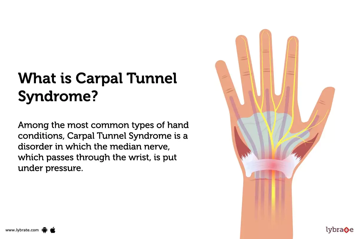 Carpal Tunnel Syndrome: Causes, Symptoms, Treatments And More
