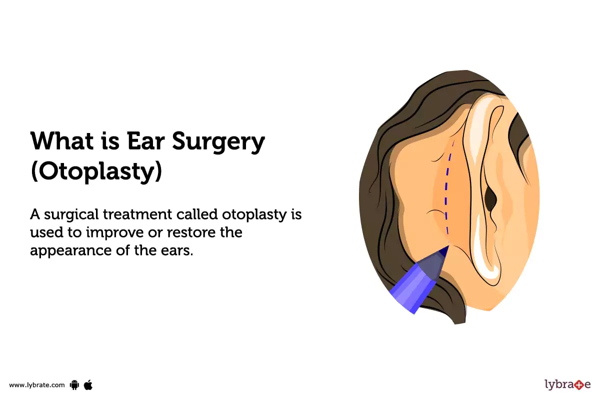 Otoplasty Causes, Treatment, Home Remedies And More!