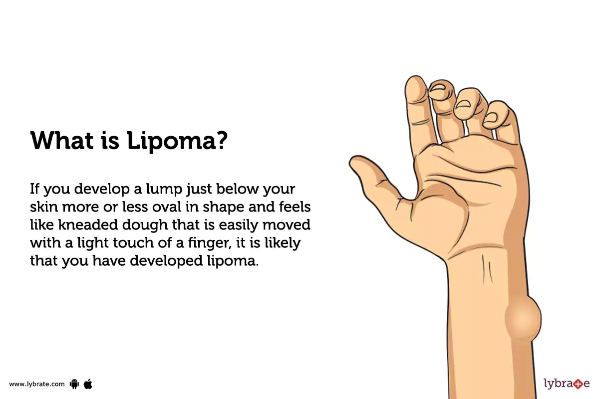 Lipoma: Symptoms, Causes, Treatment and Cost