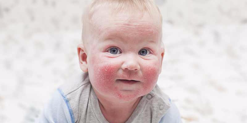 Everything You Need To Know About Eczema In Children!