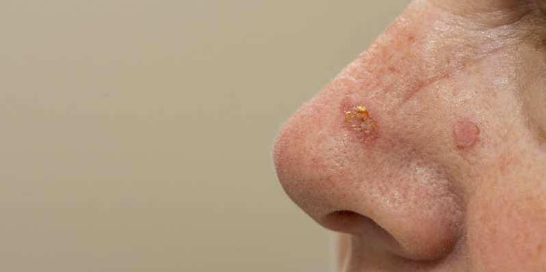 Actinic Keratosis- How To Treat It?