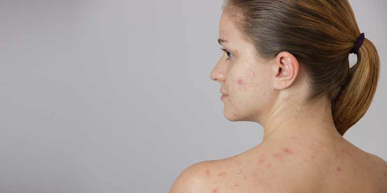 How To Deal With Carbuncles?