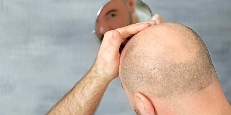 Getting Bald - What Should You Know?