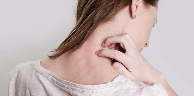 How To Prevent Summer Rashes?