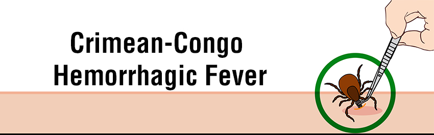 Congo Fever: Symptoms, Causes, Diagnosis, Vaccine, Treatment, Mortality ...