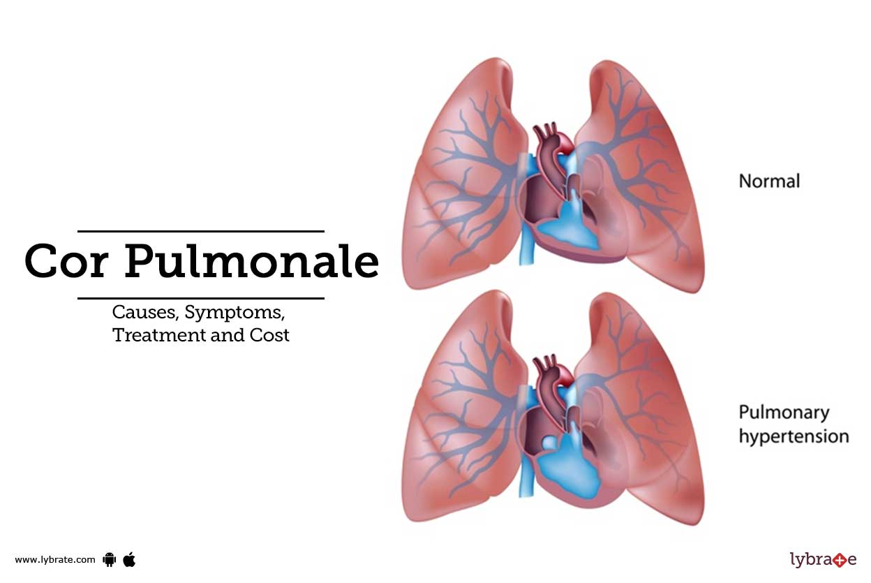 Cor Pulmonale Causes Symptoms Treatment And Cost Cor Pulmonale Causes Symptoms Treatment And Cost