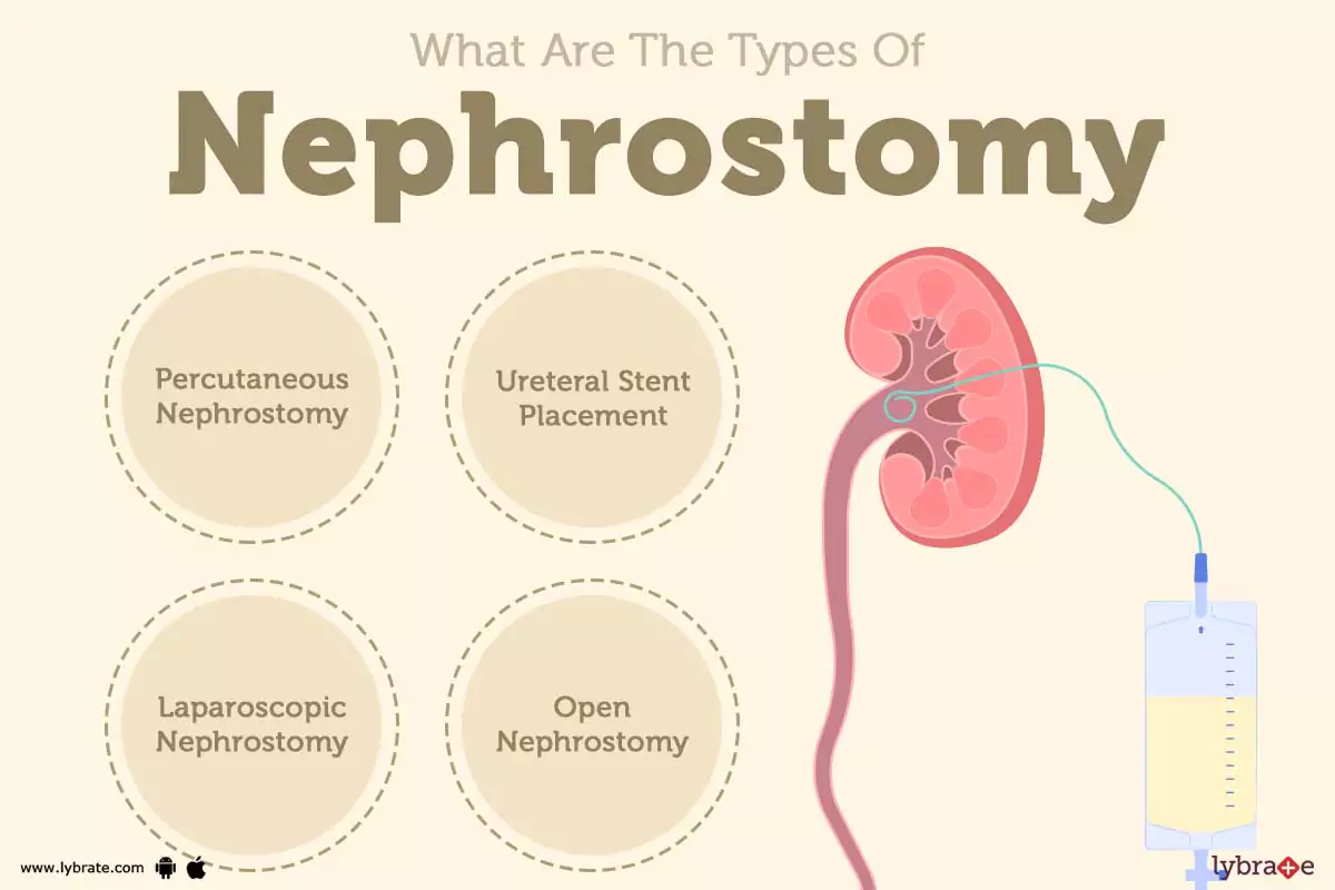 Nephrostomy Causes Symptoms Treatment And Cost Nephrostomy Causes Symptoms Treatment And Cost