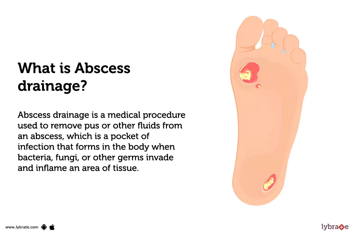 Abscess Drainage Causes Symptoms Treatment And Cost Abscess Drainage Causes Symptoms Treatment And Cost