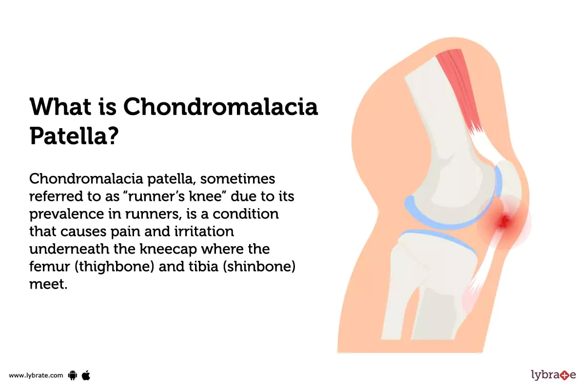 Chondromalacia Patella Signs Symptoms Complications 47 OFF