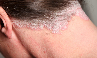 Hai I am 24 years old I have psoriasis. I conceived and its 9th week ...